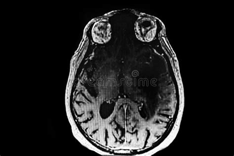 Cat Scan Of Brain Tumor Stock Photo Image Of Lobe