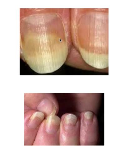 Skin Lesions Flashcards Quizlet