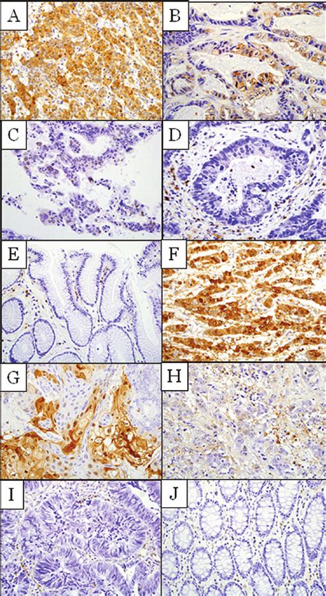 Representative Immunohistochemical Staining Pattern Of ANXA1 Expression
