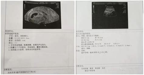 产检B超那些数字到底什么意思教您看懂B超单 孕期知识 糖糕妈妈育儿网