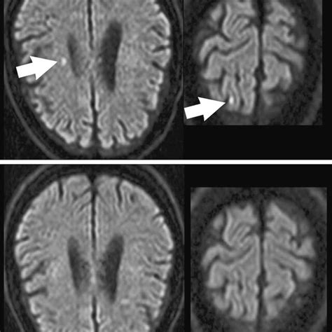 Diffusion Weighted Magnetic Resonance Images Showing No Abnormal