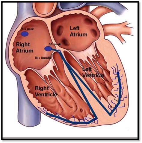 Lecture 9 Ventricular Arrhythmias Heart Blocks Flashcards Quizlet