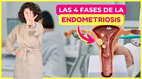 ENDOMETRIOSIS SEVERA Y EMBARAZO FASES O GRADOS De La Endometriosis