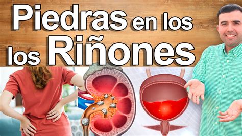 No Ignores Estos Sintomas De Piedras En Los Ri Ones Sintomas De