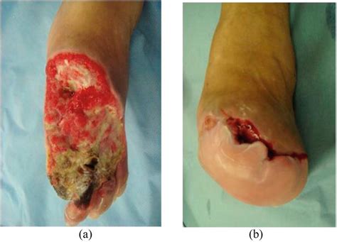 Diabetic Foot Ulcer Amputation