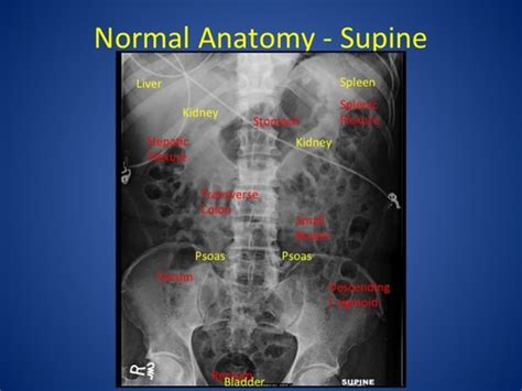 Abdominal X Ray Interpretation Flashcards Quizlet