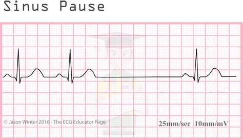 ECG Educator Blog Sinoatrial Node Rhythms