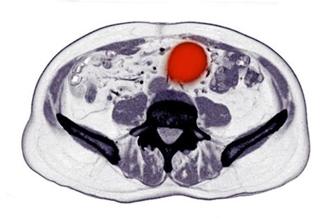 Ct Scan Images Showing An Abdominal Aortic Aneurysm Which Developed