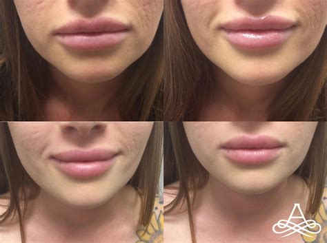 Phoenix AZLip Filler Before After Gallery