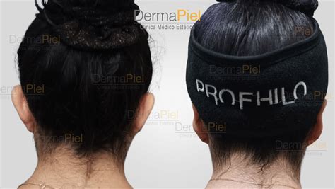 Otoplastia Dermapiel