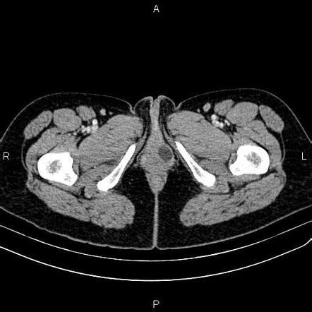 Bartholin Gland Cyst Radiology Case Radiopaedia Org