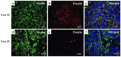 Double Immunofluorescence Staining Images Of Case 15 And 22 A C