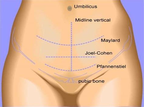 The Evidence Based Cesarean Section CREOGS Over Coffee