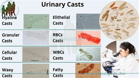 Urinary Casts A Comprehensive Guide Lab Tests Guide