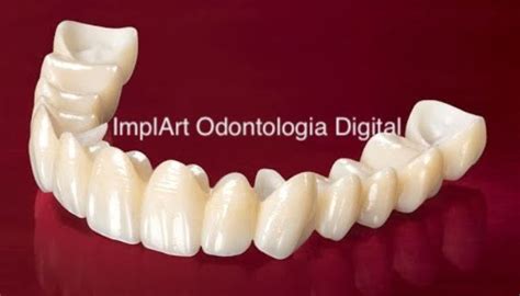 protese fixa zirconia 50kb Clínica Odontológica de Implante Dentário