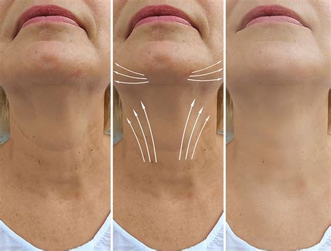 Nefertiti Lift Platysma Bands Injections Gold Coast Dc Aesthetics
