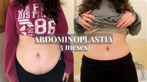 Abdominoplastia 3 Meses ANTES E DEPOIS YouTube