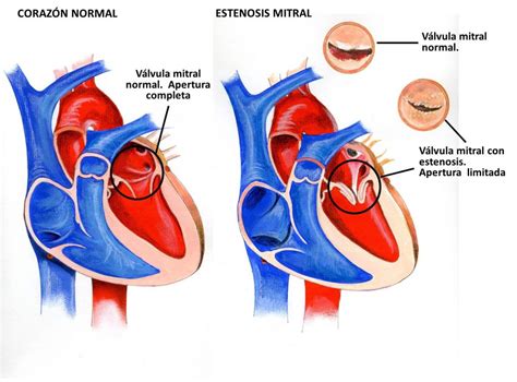 Estenosis de la válvula mitral