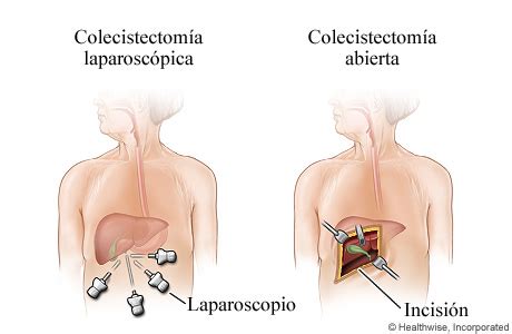 Tipos de cirugía para extirpar la vesícula biliar MedicalRecords