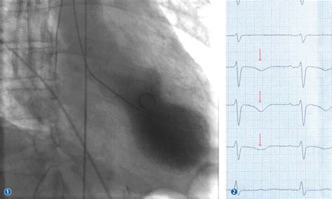 Takotsubo Ein Broken Heart Syndrom nicht übersehen