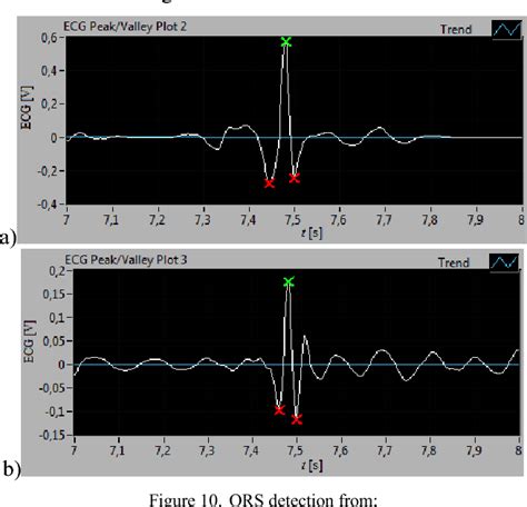 figure 10 from qrs time detection using wavelet multiresolution analysis for determining hrv in
