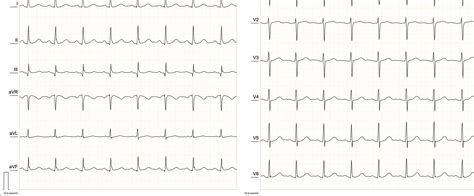 Electrocardiograma Dr Daniel Torres