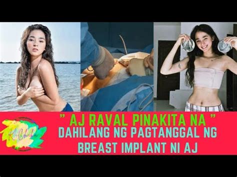 AJ Raval Tinanggal Na Ang Hinaharap Breast Implant YouTube