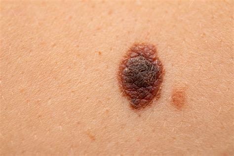 Malignant Melanoma Today Where Are We Now And Where Will We Go Pt 3