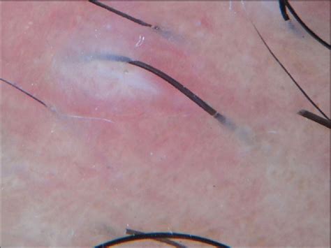 Clinical And Dermoscopic Study Of Pseudofolliculitis Of The Beard Area