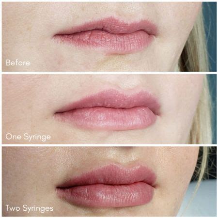 Lip Injections Juvederm Juvederm Lips Botox Cheek Fillers Facial