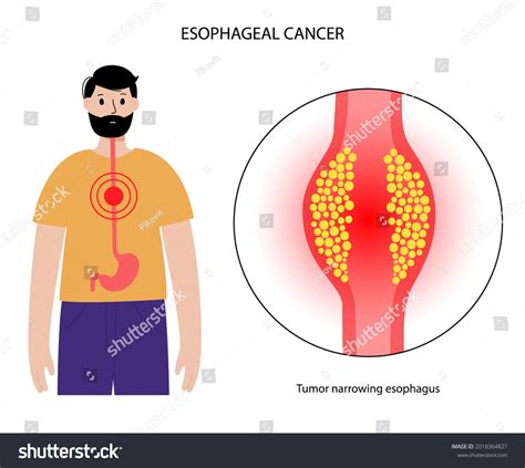 Esophageal Carcinoma Esophagus Stomach Anatomy Male Stock Vector