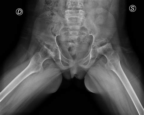 Brown Hospital Medicine On Twitter A Year Old Girl P W Bilateral