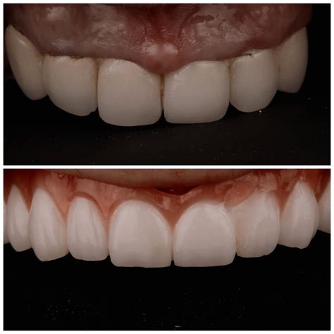 Antes y después de prótesis completa fija sobre implantes dentales