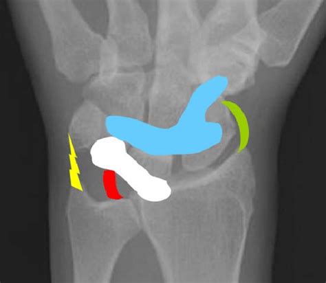 Diagram Of Dorsal Extrinsic Capsular Wrist Ligaments And Collateral