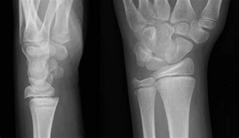 Growth Plate Fractures TeachMeSurgery