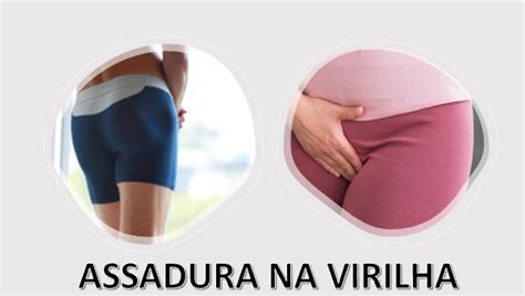 Assadura na virilha causas sintomas e tratamento Buscar Saúde