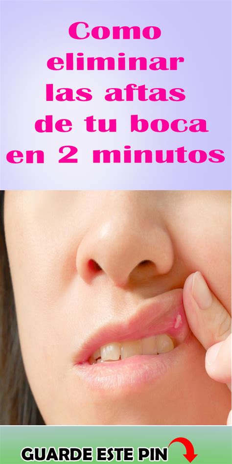 Como Eliminar Las Aftas De Tu Boca En Minutos Salud Naturales