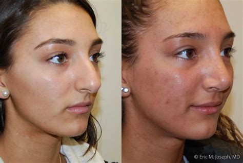 Eric M Joseph MD Rhinoplasty Before After Hump Removal And Tip