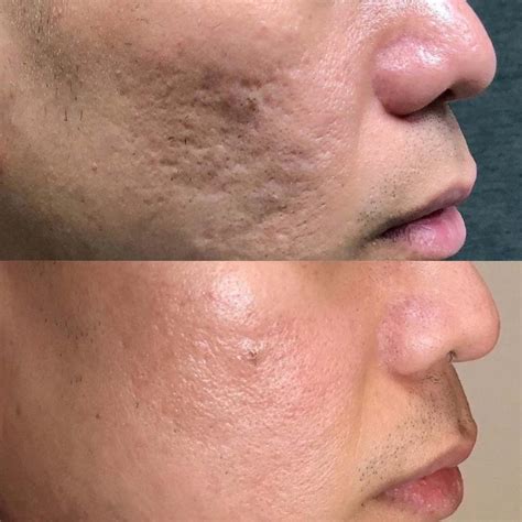 CO2 Laser For Scars Treatment All You Need To Know