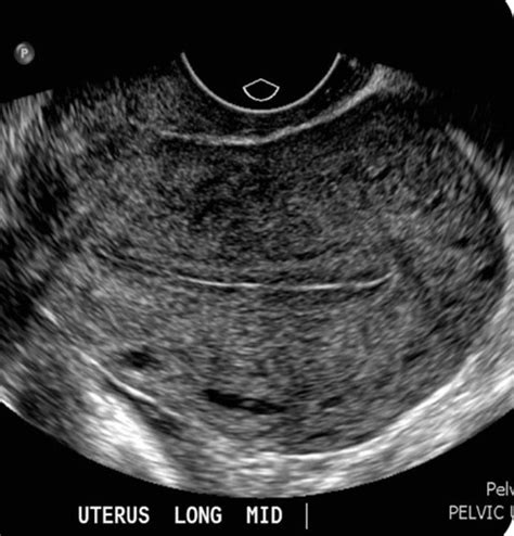 Ectopic Pregnancy Flashcards Quizlet