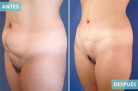 Lipectom A Antes Y Despu S Dr Nelson Chaves