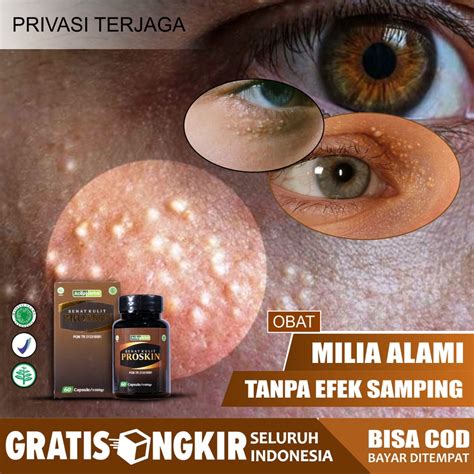 Jual Obat Penghilang Milia Di Bawah Mata Bintitan Kelopak Mata Untuk