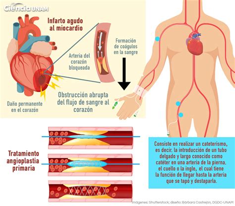Atención oportuna lo mejor para un buen pronóstico en infarto agudo al