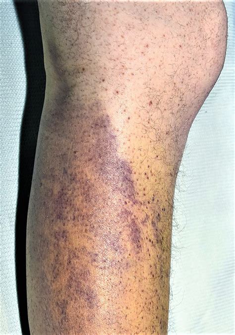 Costume Damn It Cure Iron Deficiency Bruising On Legs Amplifier
