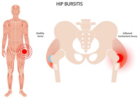 Hip Bursitis Top 9 Strengthening Exercises And Stretches Fitness Volt
