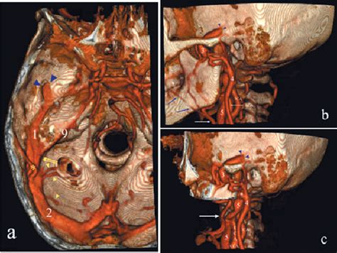 Case 2 Three Dimensional Reconstruction Of Angio CT Images Philips MX