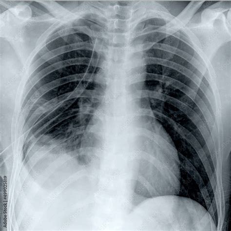 CHEST X RAY WITH COMPLICATED PNEUMONIA PLEURAL EFFUSION Stock Photo