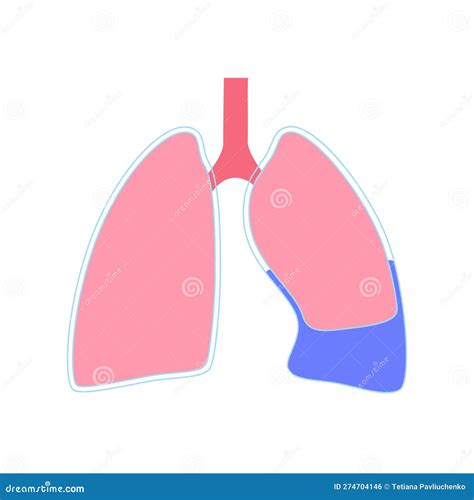 Thoracentesis Medical Procedure Cartoon Vector Cartoondealer The Best