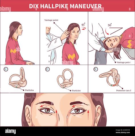 Dix Hallpike Maneuver Vector Illustration Stock Vector Image Art Alamy