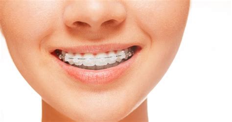 Brackets estéticos Clínica Dental Amparo Castañer